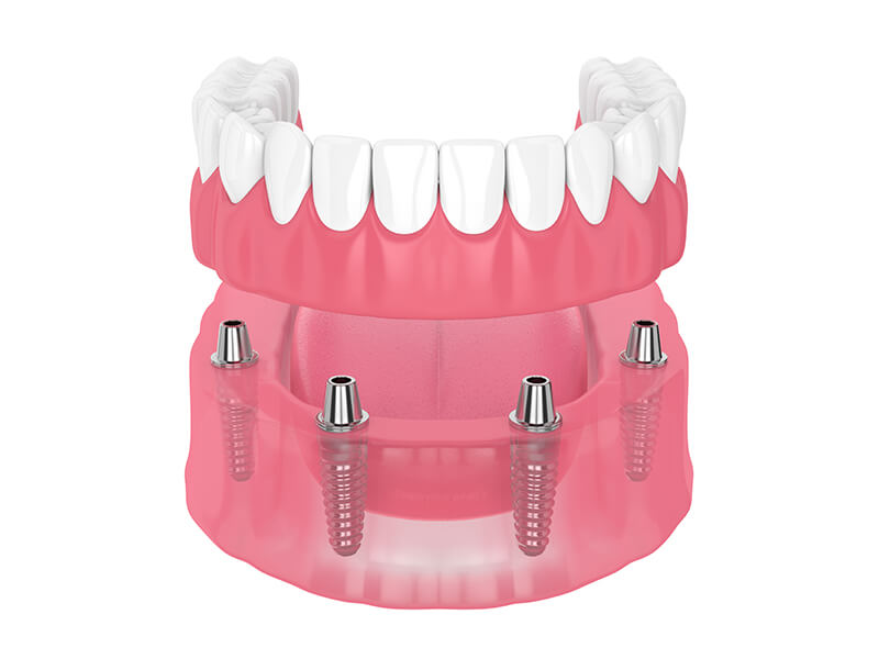 Prótese dentária em Duque de Caxias - RJ - OdontoArêas
